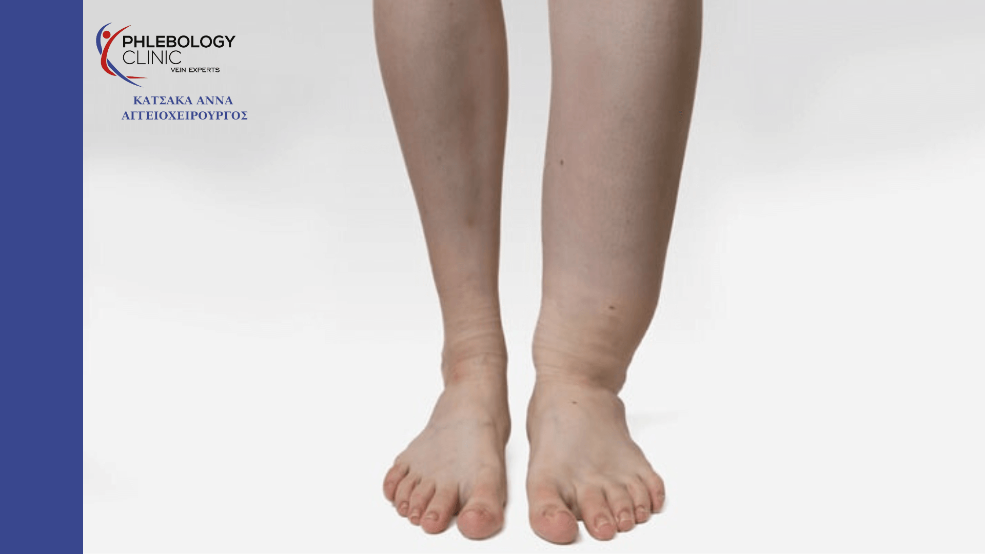 Λεμφοίδημα: Αντιμετωπίστε το έγκαιρα | Phlebology Clinic | Plastic and ...